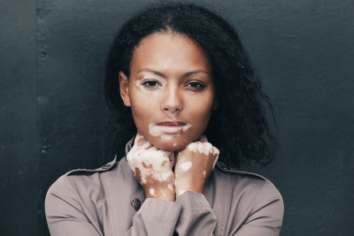 Bercak Putih di Wajah? Samarkan dengan 3 Cara Ini! | Yesdok.com