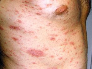 PITYRIASIS ROSEA: RASA GATAL DISERTAI BULATAN MERAH, SIMAK ...