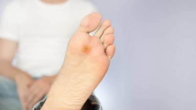 Kenali Tanda-tanda Infeksi pada Luka | Yesdok.com