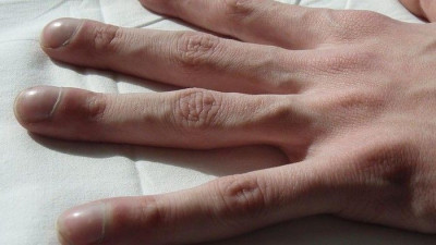 Mengenal Clubbing Finger, Gejala, Penyebab dan Perawatannya | Yesdok.com