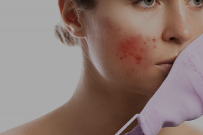 Apa Itu Folikulitis? Ini Beberapa Hal yang Harus Diketahui | Yesdok.com