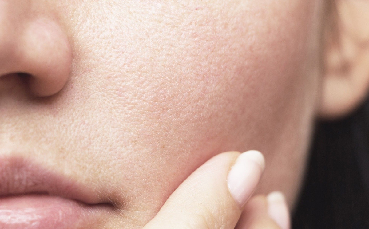 Ini Ciri Anda Alami Kulit Dehidrasi | YesDok