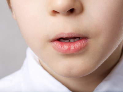 Waspadai 4 Jenis Gangguan Kesehatan Mulut Ini | Yesdok.com