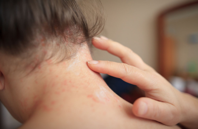 Gejala Eksim yang Timbul pada Leher | Yesdok.com