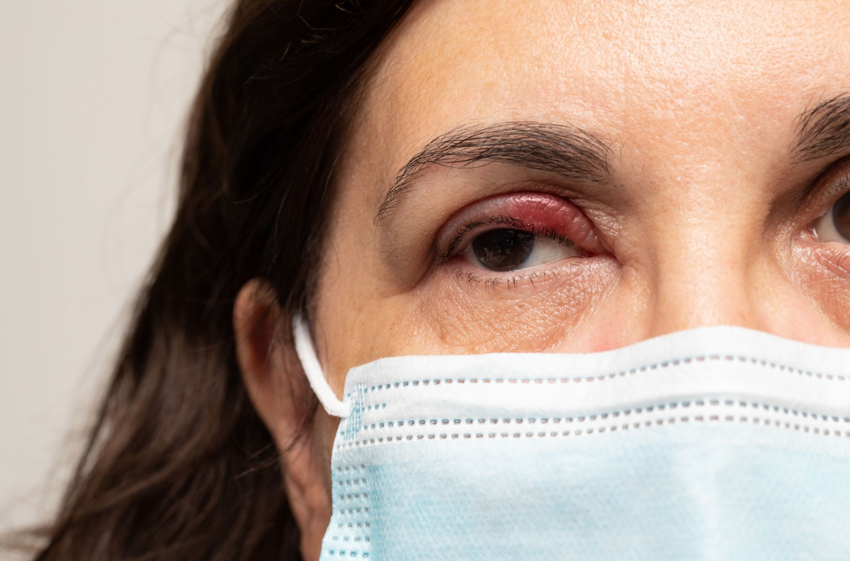 Gejala Bintitan Pada Kelopak Mata yang Perlu Anda Perhatikan | YesDok