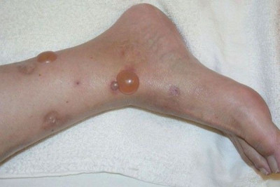 Mengenal Pemfigoid Bulosa, Penyebab, Gejala dan Cara Mengobati | Yesdok.com