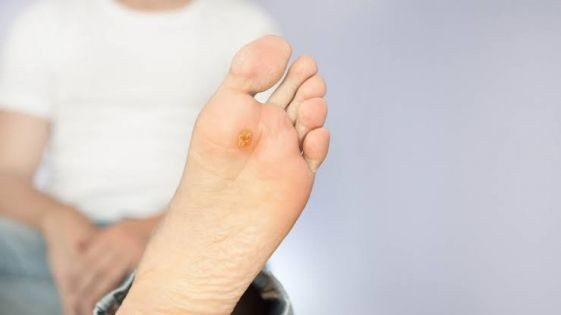 Kenali Tanda-tanda Infeksi pada Luka | YesDok