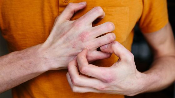 Yuk, Cari Tahu Apa Pemicu dan Gejala Eksim | YesDok