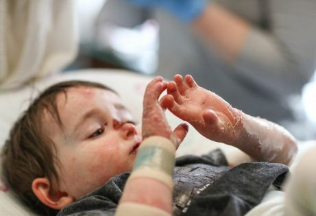 Apa Itu Epidermolisis Bulosa? Ketika Lepuh Bermunculan di Kulit | YesDok