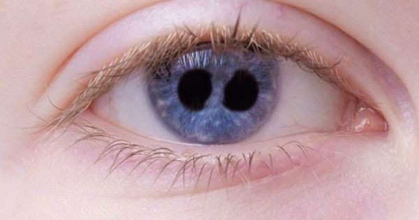 Polycoria, Kondisi Langka Munculnya Dua Pupil dalam Satu Mata | YesDok