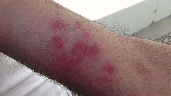 Gigitan Kutu Kasur Apakah Bisa Berbahaya? Ini Gejala dan Pengobatannya ...