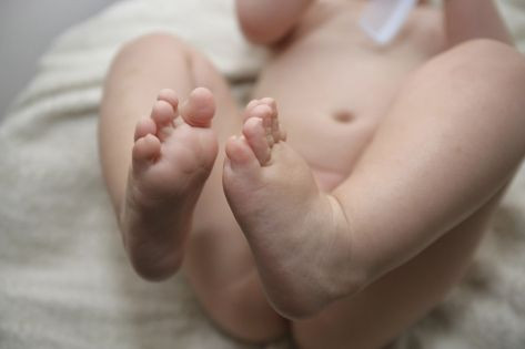 Gejala Psoriasis Pada Bayi dan Perawatannya | YesDok